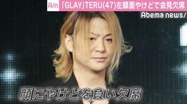GLAY・TERU、左顔面のやけどで会見欠席 メンバーのイジりに「汗をかかせないで」 | 国内 | ABEMA TIMES