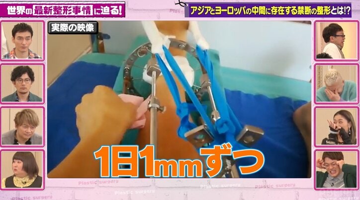 【写真・画像】「骨を折って、固定器具を…」身長10cmアップ・31歳男性が受けた“骨延長手術”の実態 3枚目 | バラエティ | ABEMA TIMES | アベマタイムズ