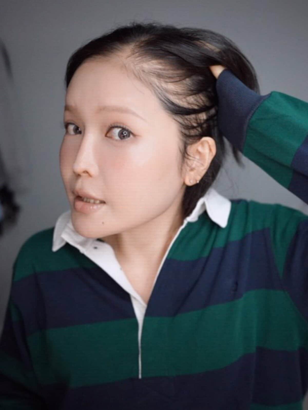 34歳で余命宣告を受けたYouTuber・ミミポポ、抗がん剤治療の“副作用”を報告「毎日バッサバッサ抜けて」 | エンタメ話題 | ABEMA TIMES | アベマタイムズ